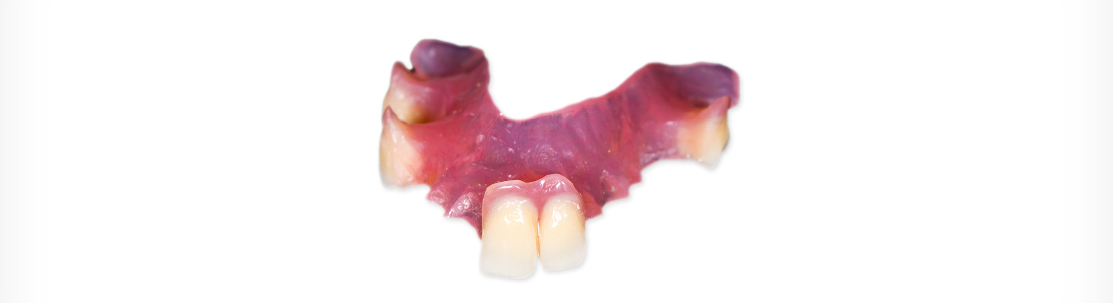 Temporär partiell protes – Denzir